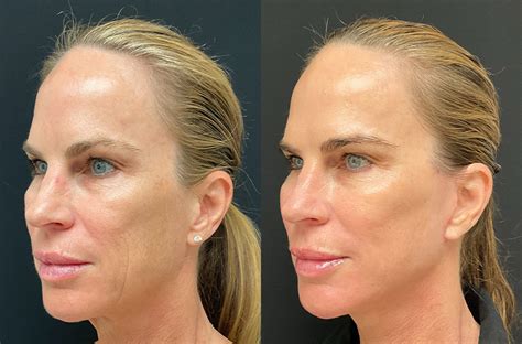 Mini Facelift Before And After Photos Encinitas Ca