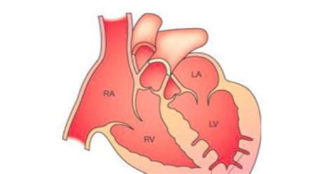 Hypertrabéculation Vg Du Sportif Club Des Cardiologues Du Sport