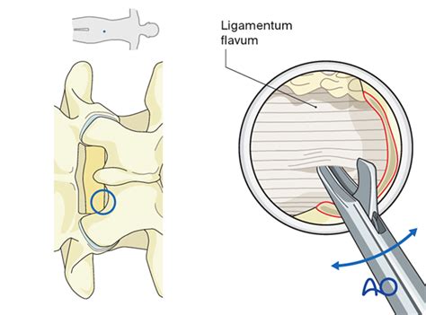 Interlaminar Endoscopic Lumbar Discectomy Ield For Lumbar Disc Herniation Central And