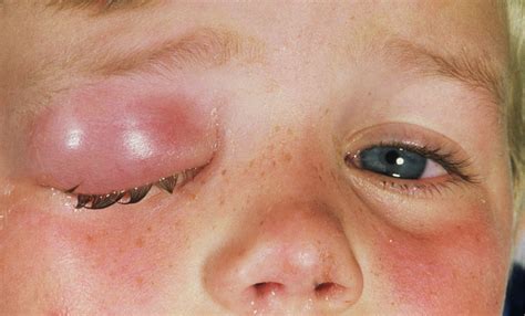 The Unilateral Red Eye Gp Eyes