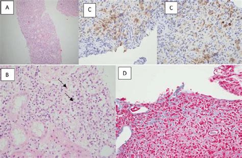 A Cd130 Plasma Cells Infiltration In The Interstitium Under Low Power