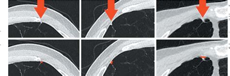 Figure 1 From Pleural Adhesion Assessment As A Predictor For