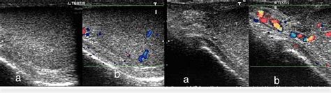 Ultrasound Left Testis A Greyscale Image Showing Hypoechoic Echo