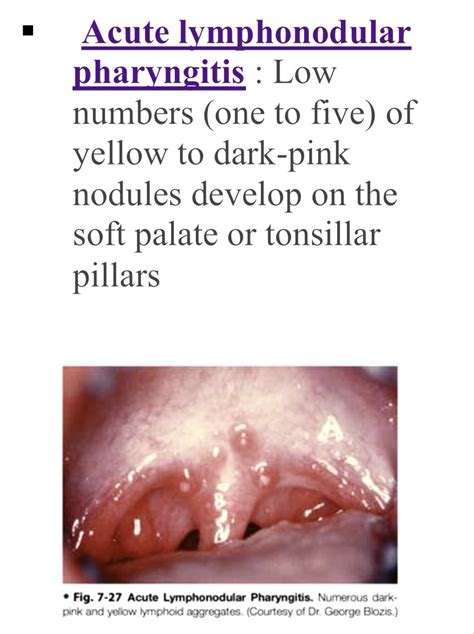 Acute Lymphonodular Pharyngitis
