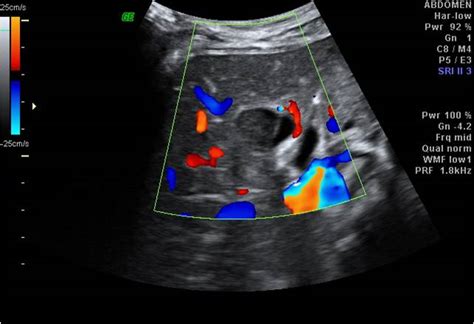 Gall Bladder Wall Cyst Possibly Submucous Cyst An Ultrasound