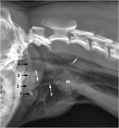 Frontiers Larynx Trauma And Hyoid Bone Fracture After Bite Injury In