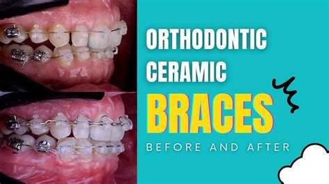 Braces Before And After Tongue Thrust At Conrad Williams Blog