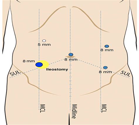 Robotic Total Intracorporeal Completion Proctectomy With Res