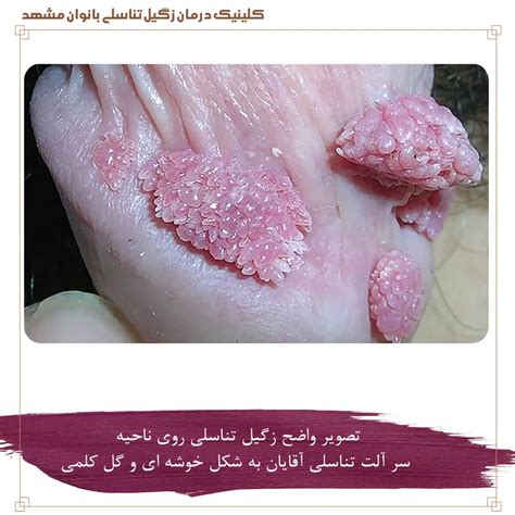 عکس زگیل تناسلی در زنان و مردان کلینیک زگیل تناسلی مشهد