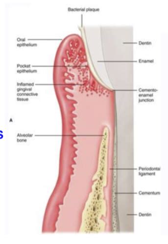 Perio Final Gingivitis Flashcards Quizlet