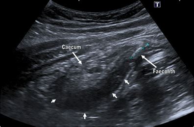 Ultrasound Assessment Of Acute Appendicitis In Paediatric Patients