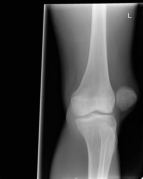 Patella Dislocation 2 Dont Forget The Bubbles