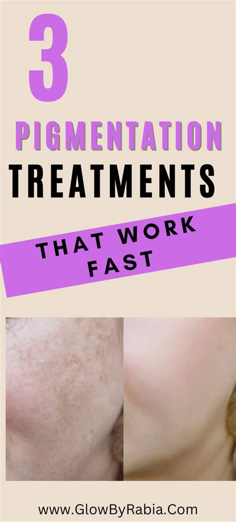 Hyperpigmentation How To Even Skin Tone Without Bleaching Artofit