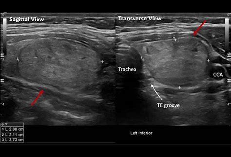 Shrinking Thyroid Nodules With Radiofrequency Ablation