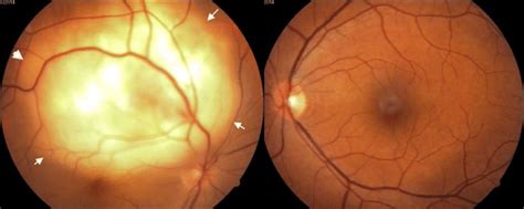 Re Showing Subretinal Mass Lesion White Arrows Demarcating The Outline