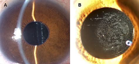 Figure 1 From Pseudoexfoliative Material On The Iol Surface And