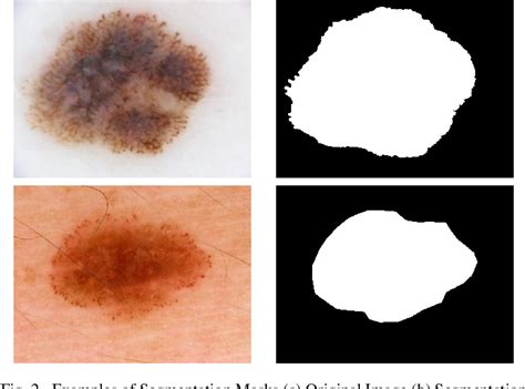 figure 2 from automatic lesion boundary segmentation in dermoscopic