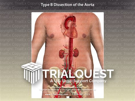Type B Dissection Of The Aorta