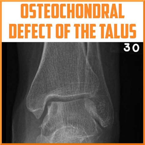 Osteochondral Defect Of The Talus Sports Medicine Review