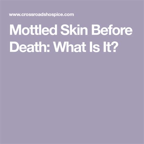 What Is Mottling Of The Skin Before Death At Robert Huang Blog