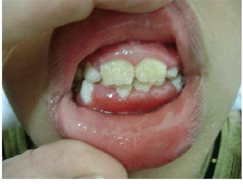 Gingival Hypertrophy Download Scientific Diagram