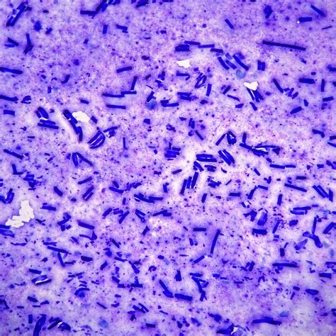 What Is Your Opinion On This Thyroid Cytology🙏🏻 Fatemeh Moosavi