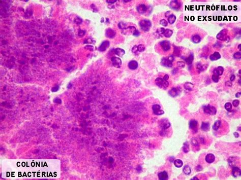 Streptococcus Milleri Grupo Grupo Streptococcus Milleri