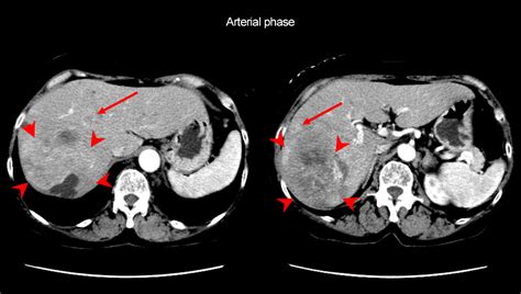 Usefulness Of Gadoxetate Disodiumgd Eob Dtpa Contrast Magnetic