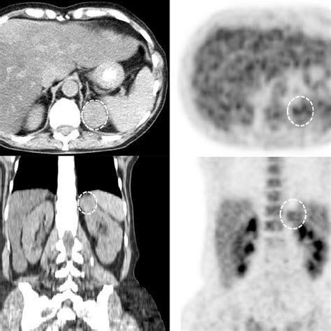 Abdominal Ct And Pet Scan In Our Patient With Hypercalcemia Top Left