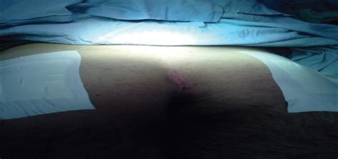 Pilonidal Sinus Minimal Excision And Primary Closure Under The Egyptian Journal Of Surgery