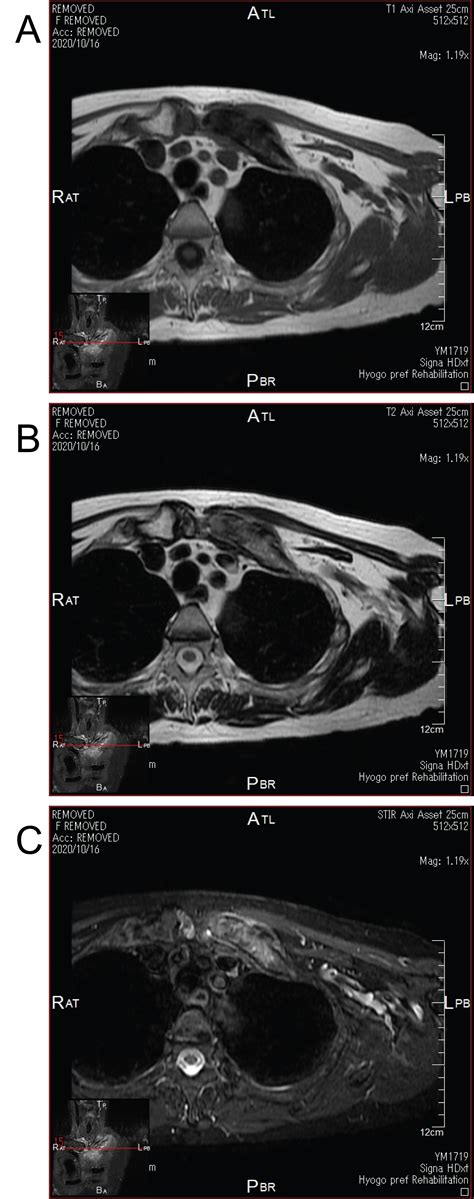 Rapid Progression Of Sternocostoclavicular Hyperostosis Scch Observed