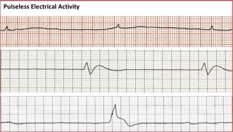 Acls Pulseless Electrical Activity And Asystole Guide Hot Sex Picture
