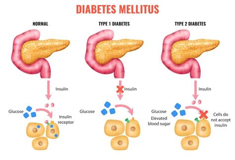 Diabetes Mellitus Tipo 1 Endometriosis And Insulin Dependent Diabetes