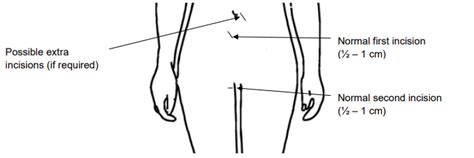 Diagnostic Laparoscopy Worcestershire Acute Hospitals Nhs Trust