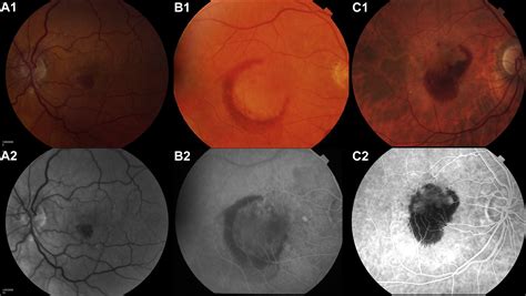 Association Between Antiplatelet Or Anticoagulant Drugs And Retinal Or