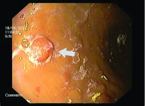 Upper Digestive Endoscopy Atrophic Gastritis Sessile Polyp Arrow Download Scientific Diagram
