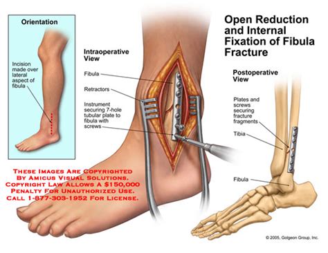 Best Orthopaedic Hospital In India Orif Fixation