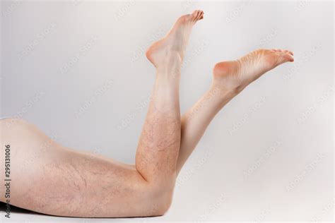 The Concept Of Varicose Disease And Medicine The Woman Lies On Her