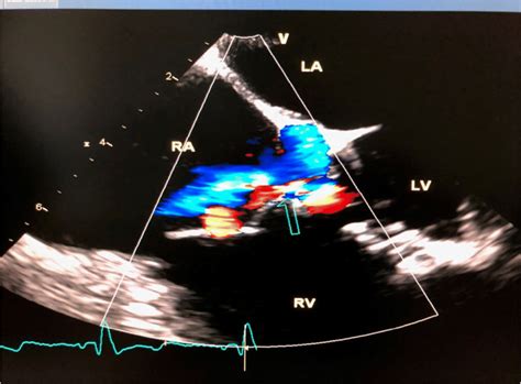 Transesophageal Image Demonstrating A Direct Type I Gerbode Defect Download Scientific