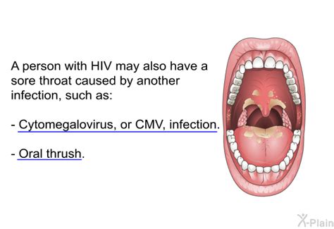Sore Throat Hiv