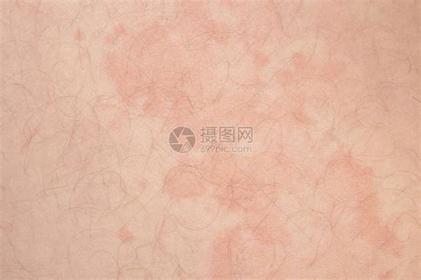 皮肤病荨麻疹皮肤红斑和瘙痒高清图片下载 正版图片504203200 摄图网