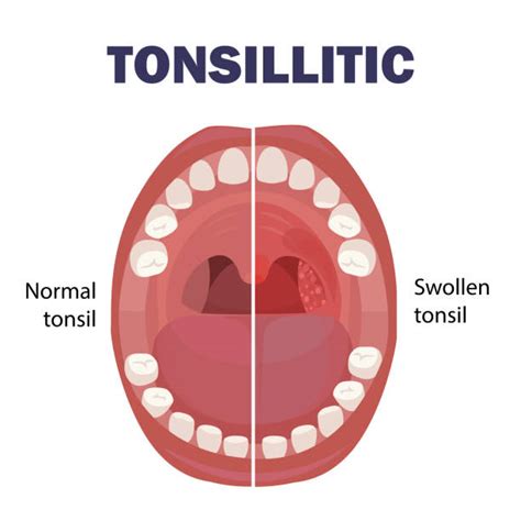 Best Tonsillitis Illustrations Royalty Free Vector Graphics And Clip Art