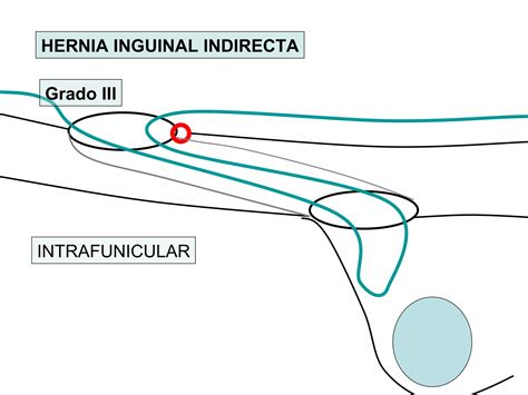 Grados De Hernia Inguinal Pps