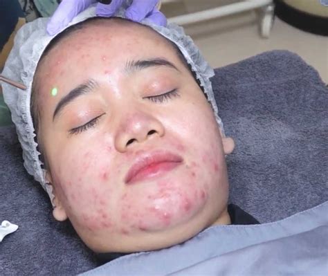 Acne Scars Dr Belle Aesthetic Clinic