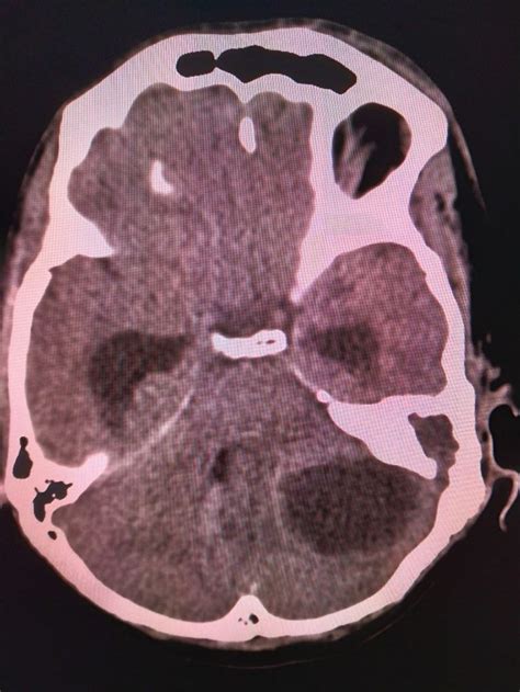 Cerebellar Abscess Secondary To Chronic Mastoiditis In 2024 Radiology