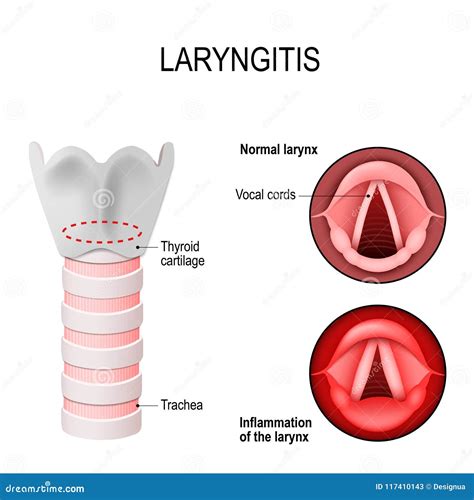 Laryngitis Cartoons Illustrations And Vector Stock Images 562 Pictures