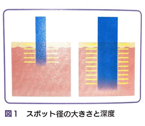 医療脱毛の出力とスポットサイズの関係