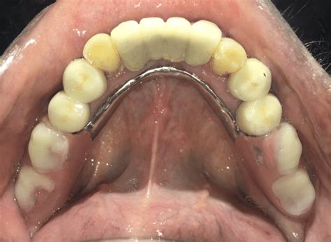 Delivered Precision Attachment Prosthesis Download Scientific Diagram