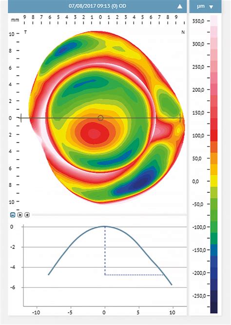 Analysis Of Corneo Scleral Measurements And Ocular Biometry As