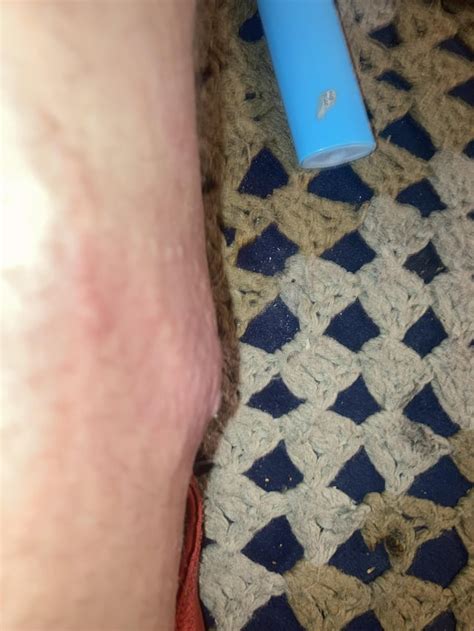 Infected Inner Thigh Boil Rpopping